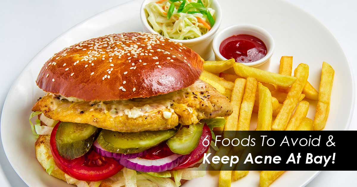6 Foods To Avoid And Keep Acne At Bay!